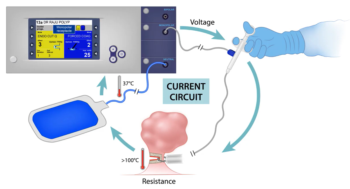 News - A New Weapon for Minimally Invasive Surgery! Disposable Snares ...